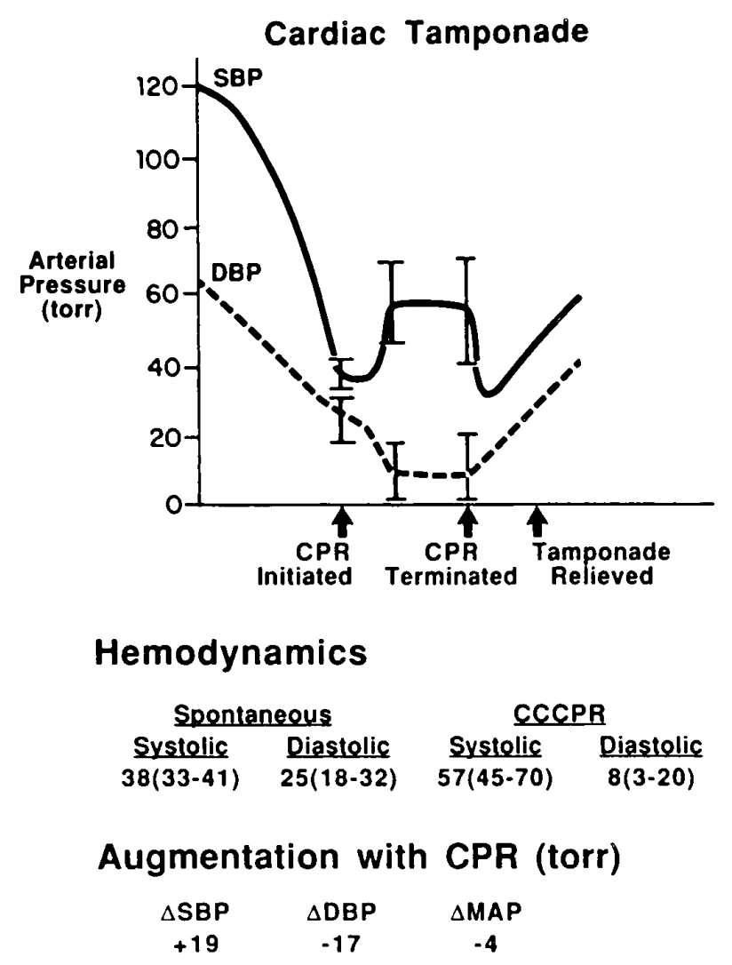 It’s Tamponade – Now What? | resusme
