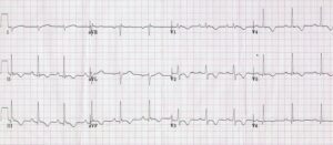 Spot the WOBBLER in syncope! | resusme