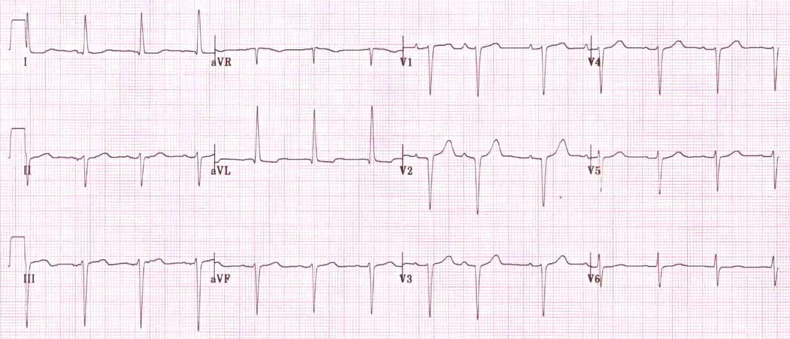 Spot the WOBBLER in syncope! | resusme
