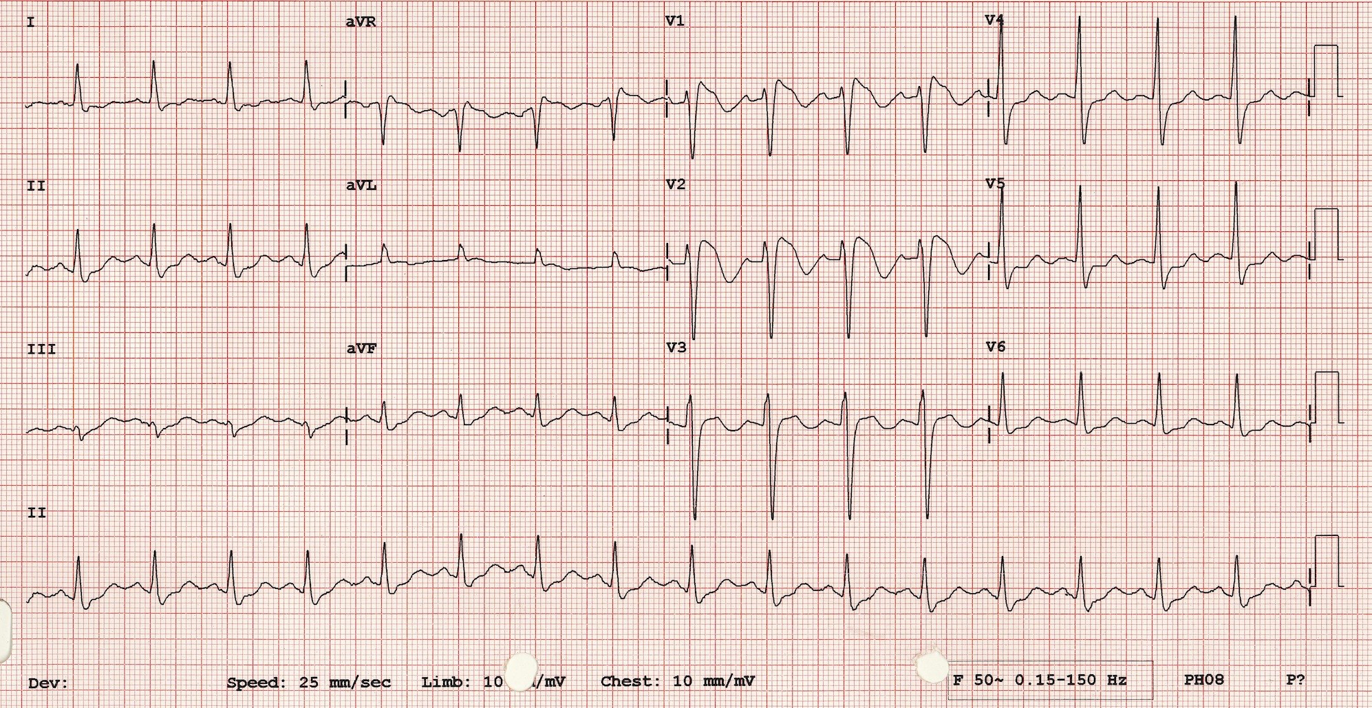 Spot the WOBBLER in syncope! | resusme