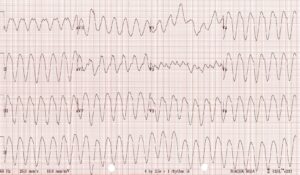 Spot the WOBBLER in syncope! | resusme