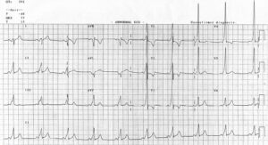 Spot the WOBBLER in syncope! | resusme