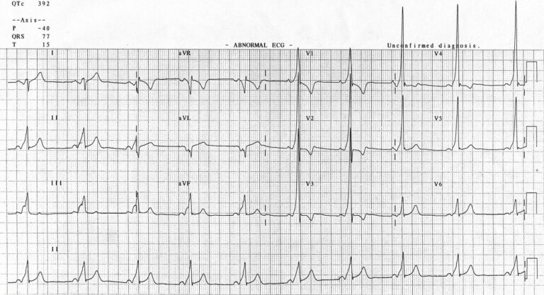 Spot the WOBBLER in syncope! | resusme